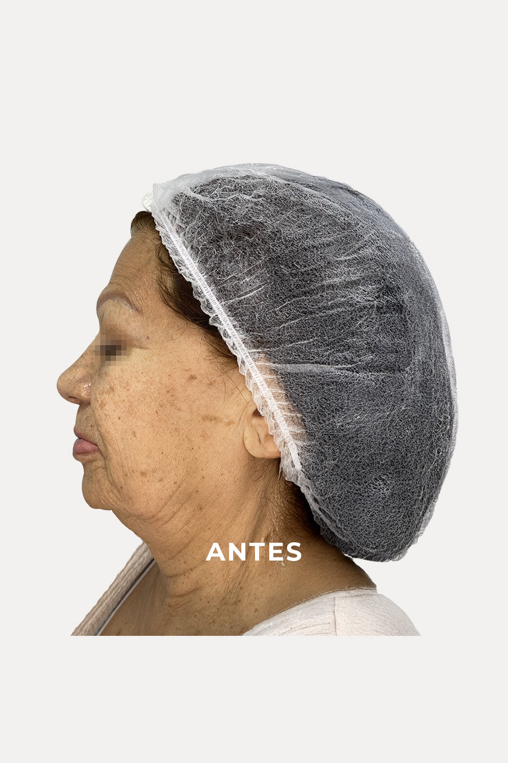 Smartlifting Láser Intraoral – Aquamed Perú