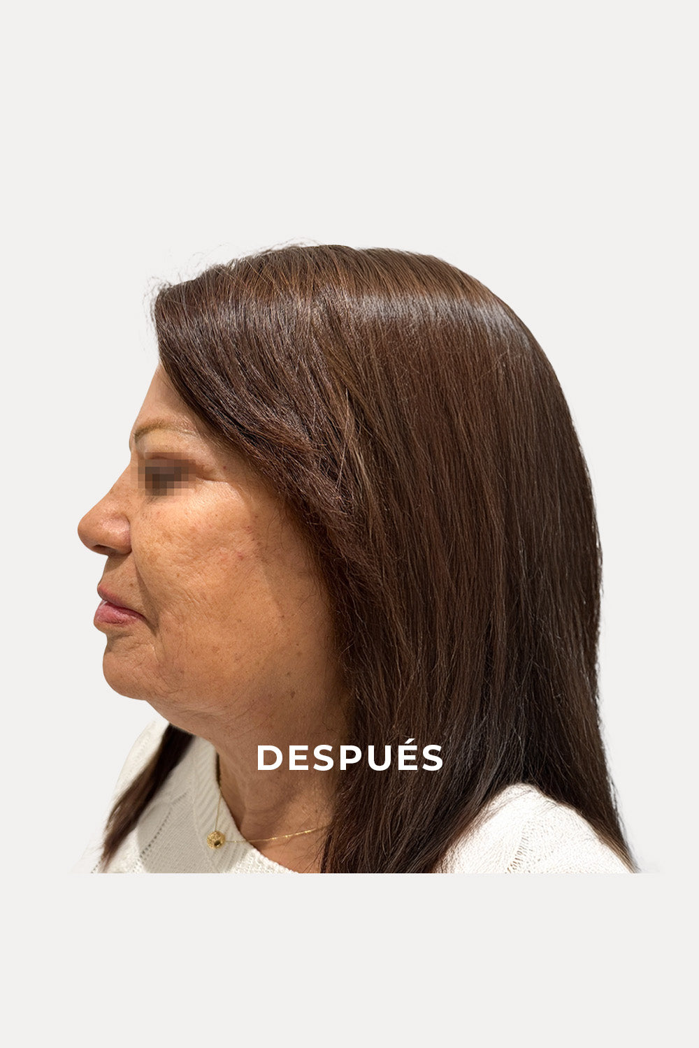 Smartlifting Láser Intraoral – Aquamed Perú