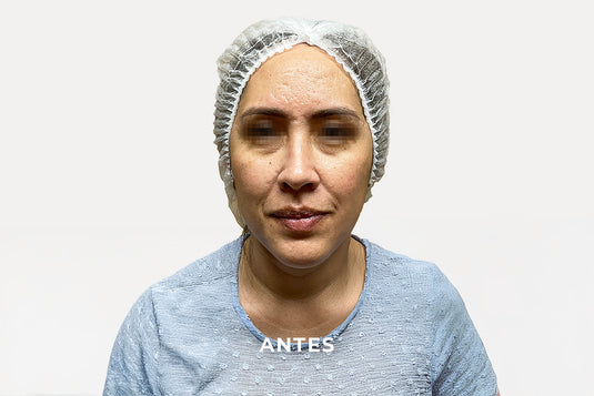 Smartlifting RF Facial – Aquamed Perú